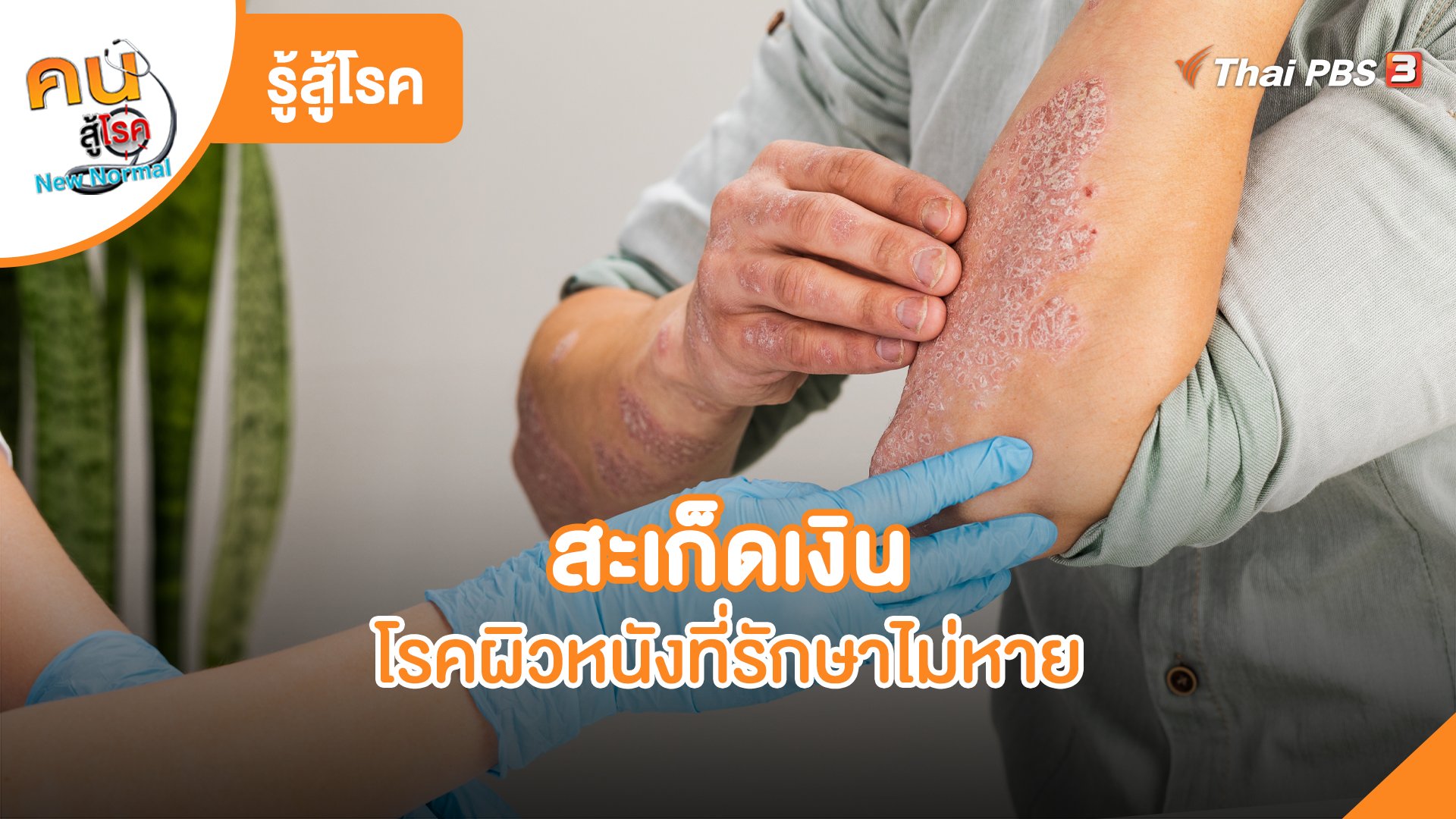 คนสู้โรค - รู้สู้โรค : สะเก็ดเงินโรคผิวหนังที่รักษาไม่หาย | Thai PBS ...