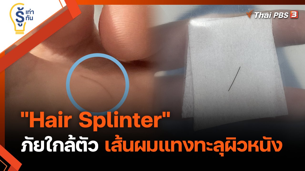 รู้เท่ารู้ทัน : "Hair Splinter" ภัยใกล้ตัว เส้นผมแทงทะลุผิวหนัง | Thai ...